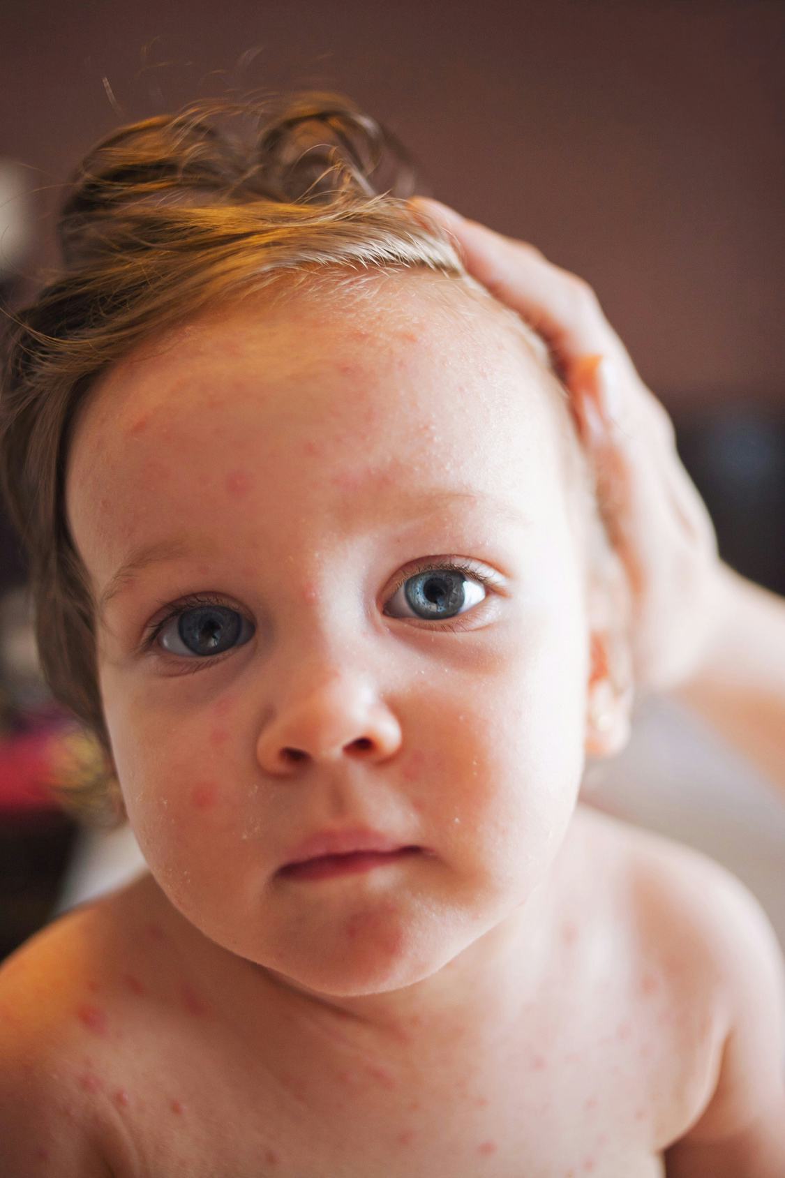 11 Signs You Should Get Your Child's Rash Checked Out