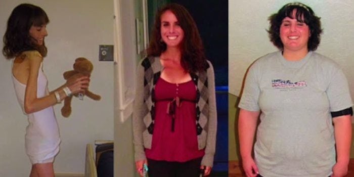 Anorexia, Bulimia And Binging: How I Went From 56 To 221 Pounds