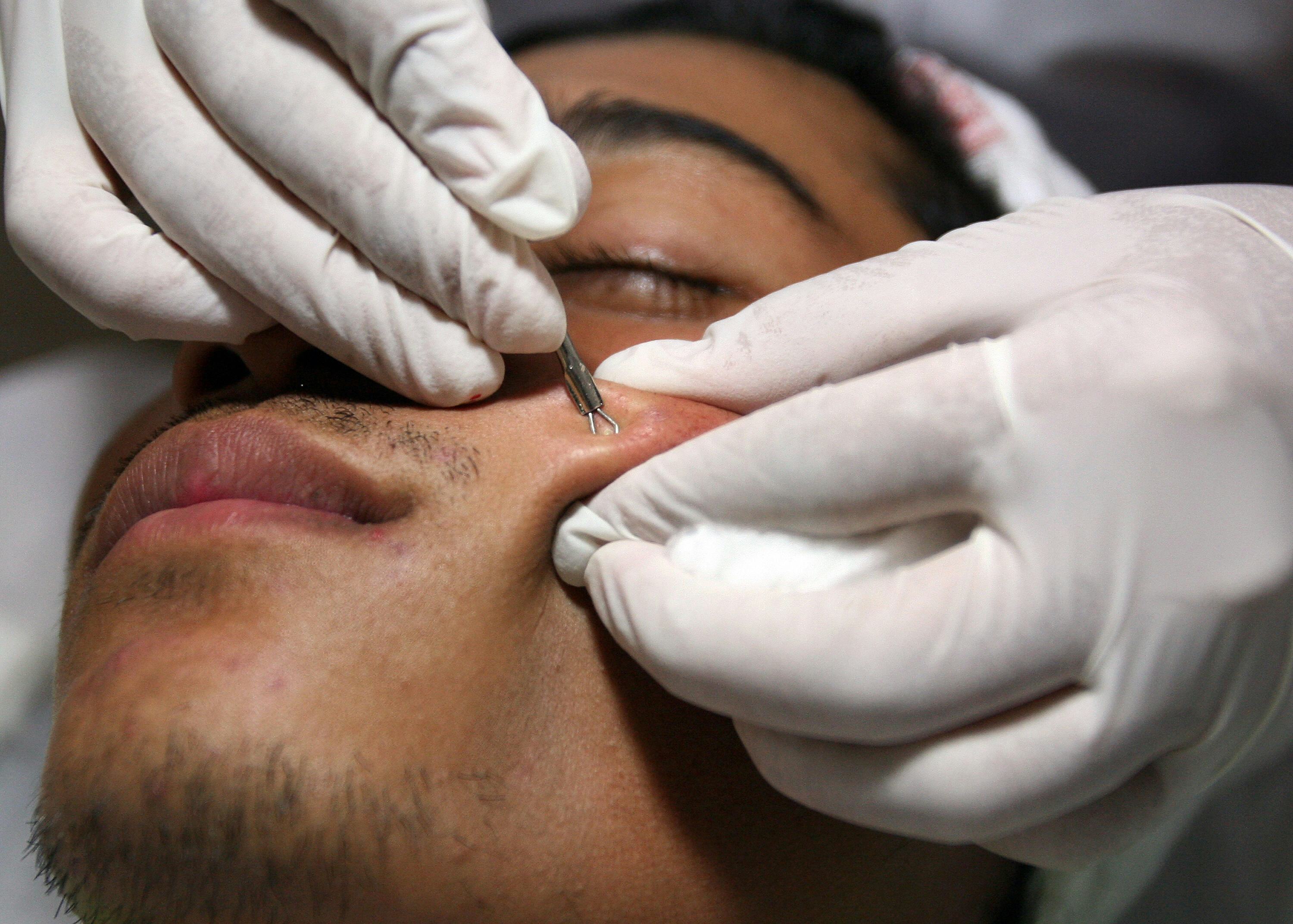 The One Thing You Should Never Do When Popping A Zit