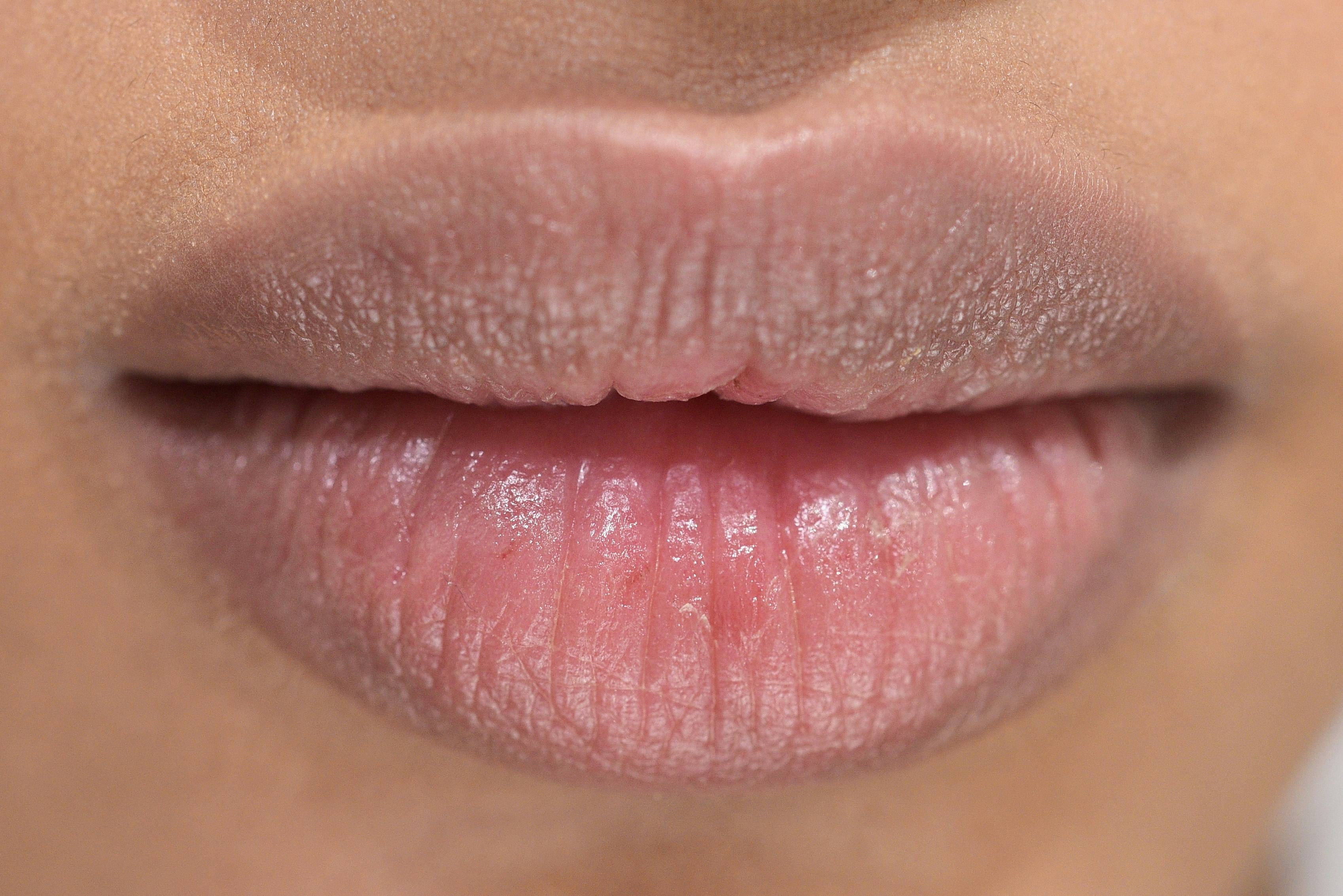 How To Treat Chapped Lips Overnight In Three Easy Steps — PHOTOS